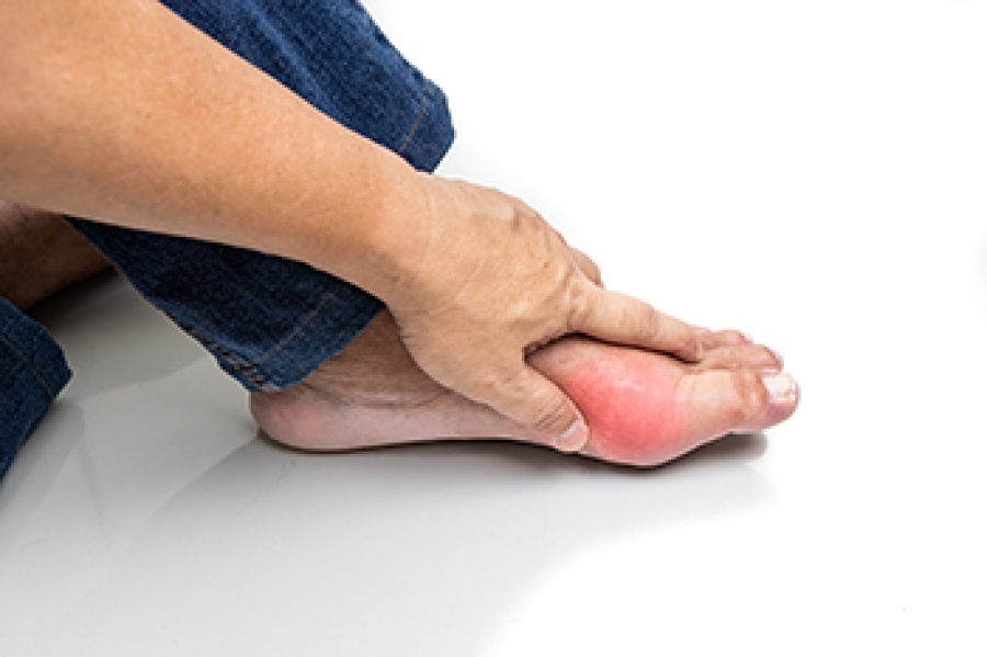 Symptoms and Causes of Gout